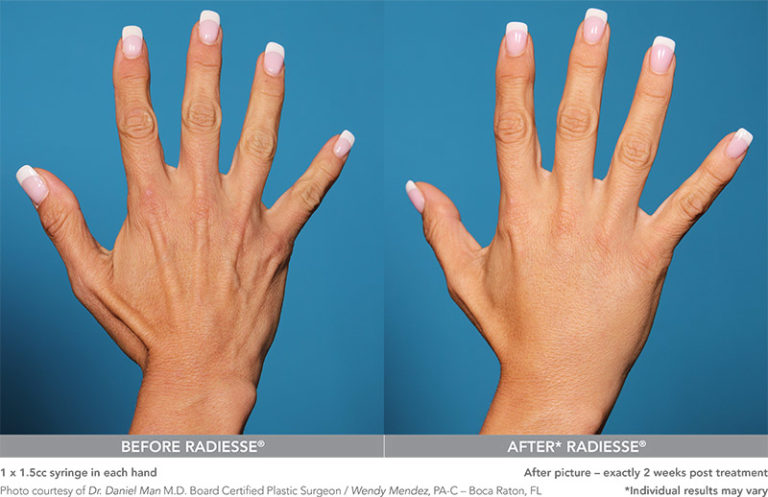 Radiesse | Darst Dermatology: Charlotte Dermatologist