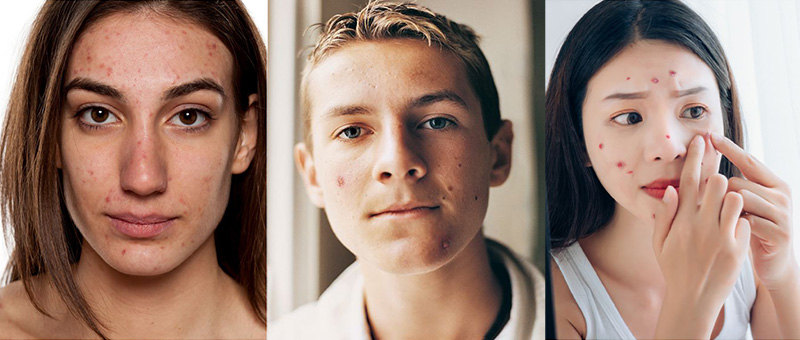 Do You Or Someone You Love Have Acne? Clinical Trial in Charlotte, NC