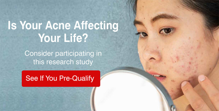 Acne Clinical Trials | Darst Dermatology: Charlotte Dermatologist