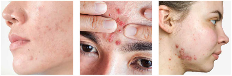 Acne Clinical Trials | Darst Dermatology: Charlotte Dermatologist